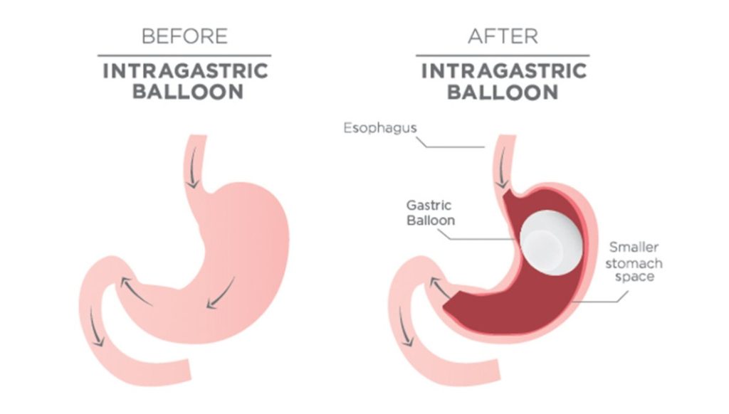 Gastric Balloon : Bariatric Antalya | Op. Dr. Murat Aynaci – Gastric ...